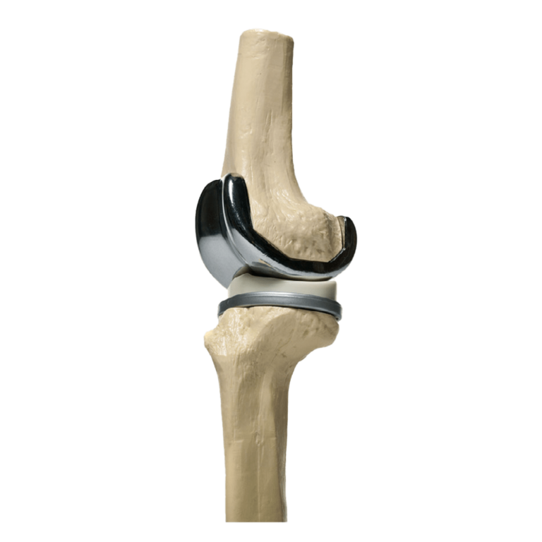 Prótesis de rodilla - Dr. Héctor González
