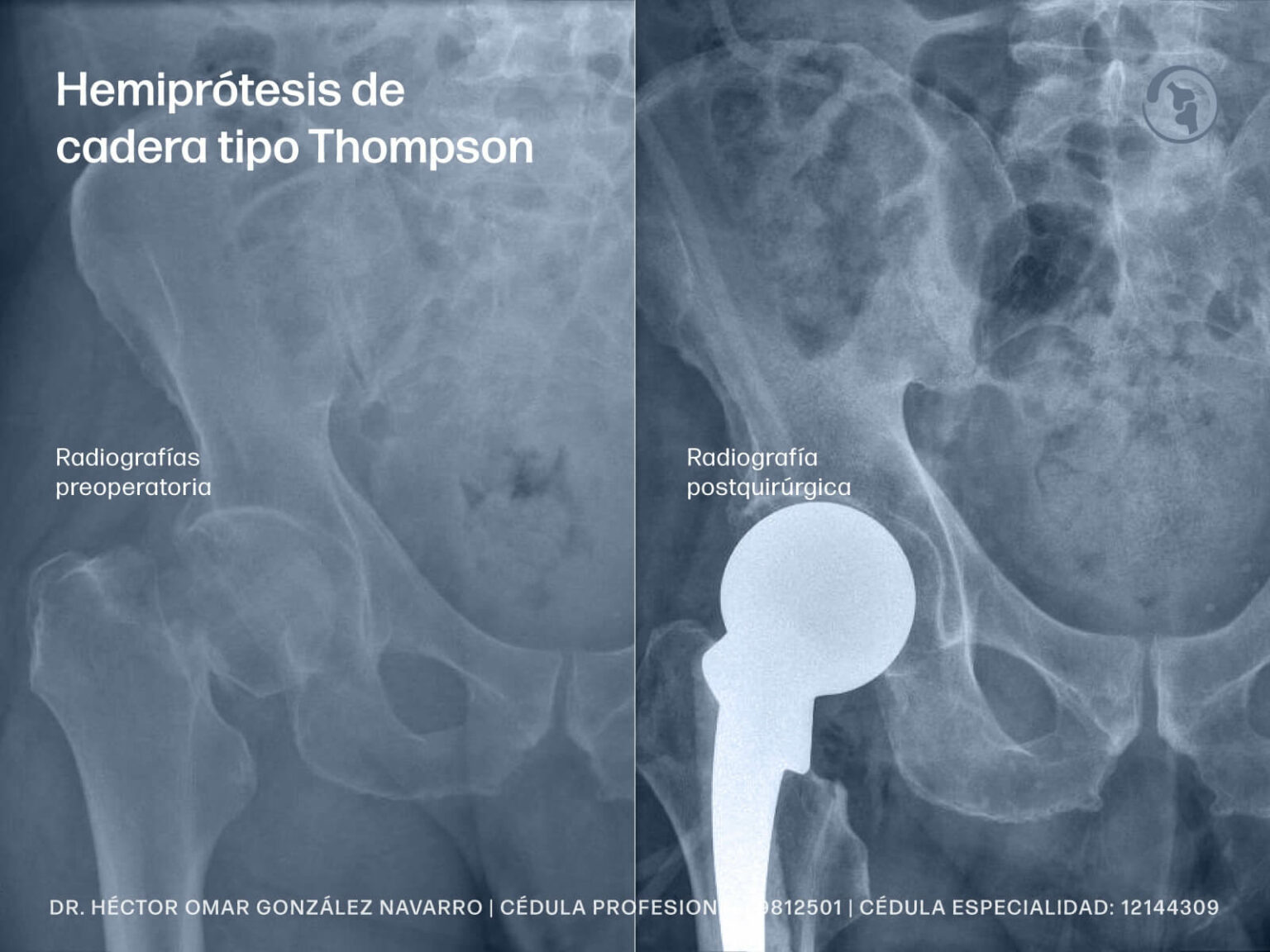 Dolor y lesiones en la cadera - Dr. Héctor González