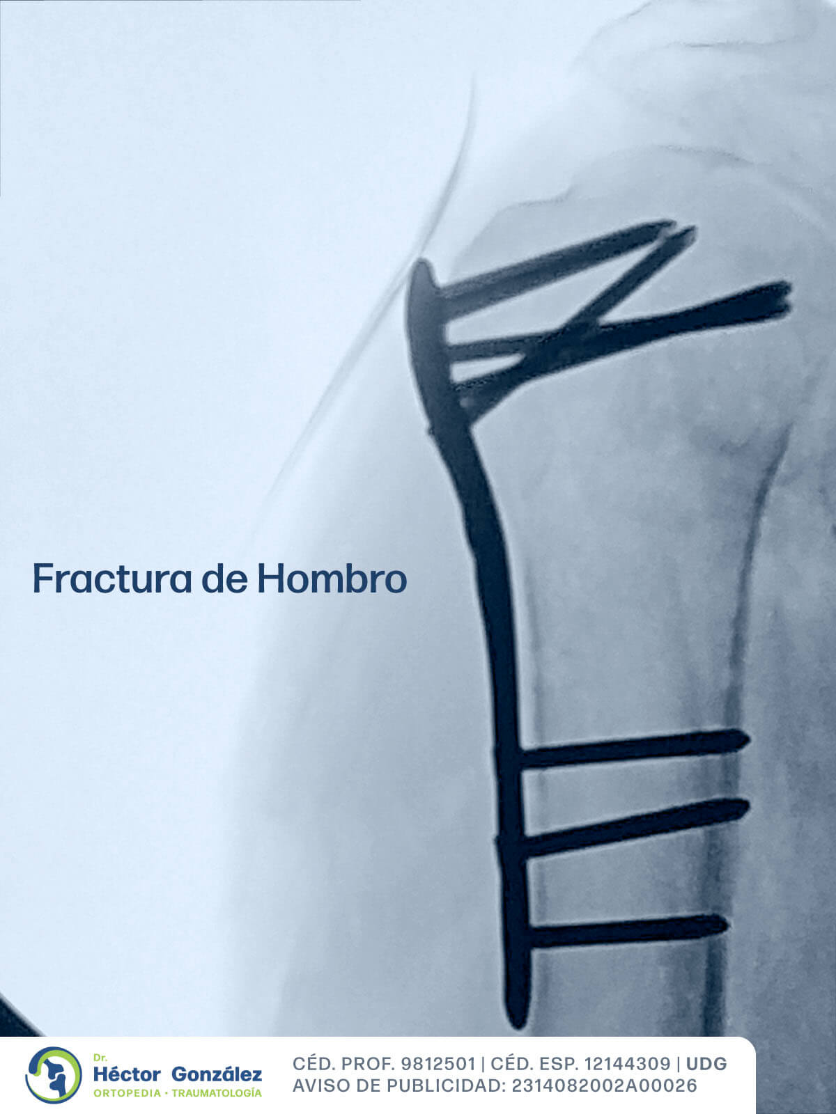 Fracturas óseas y su tratamiento - Dr. Héctor González